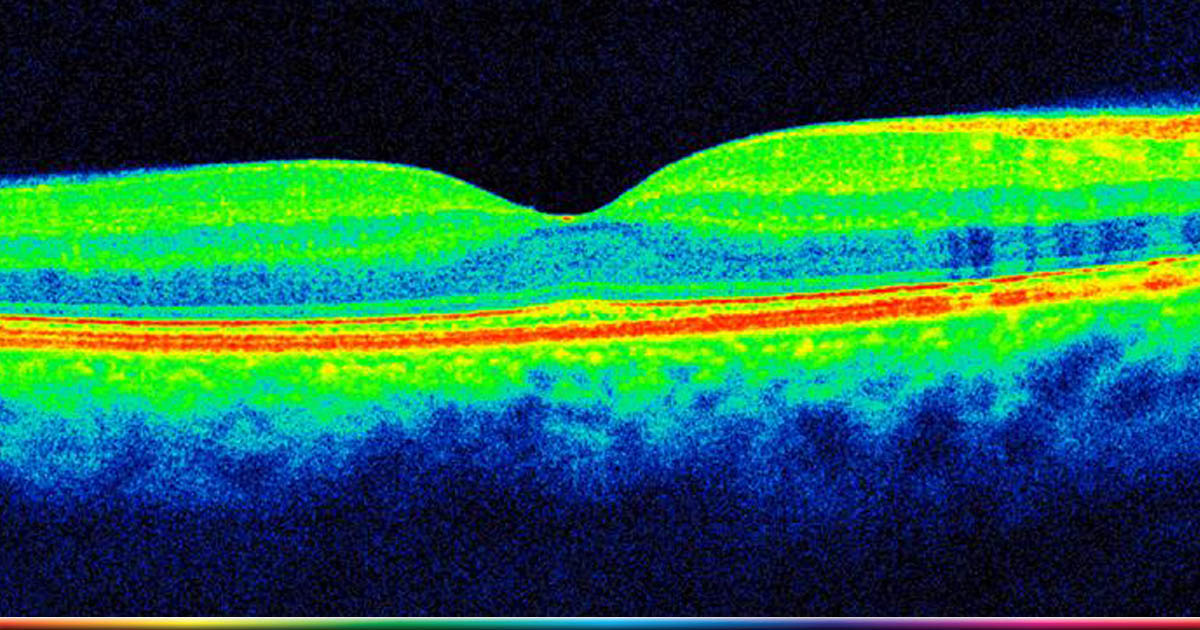Optical Coherence Tomography - OCT allows us to see more than before